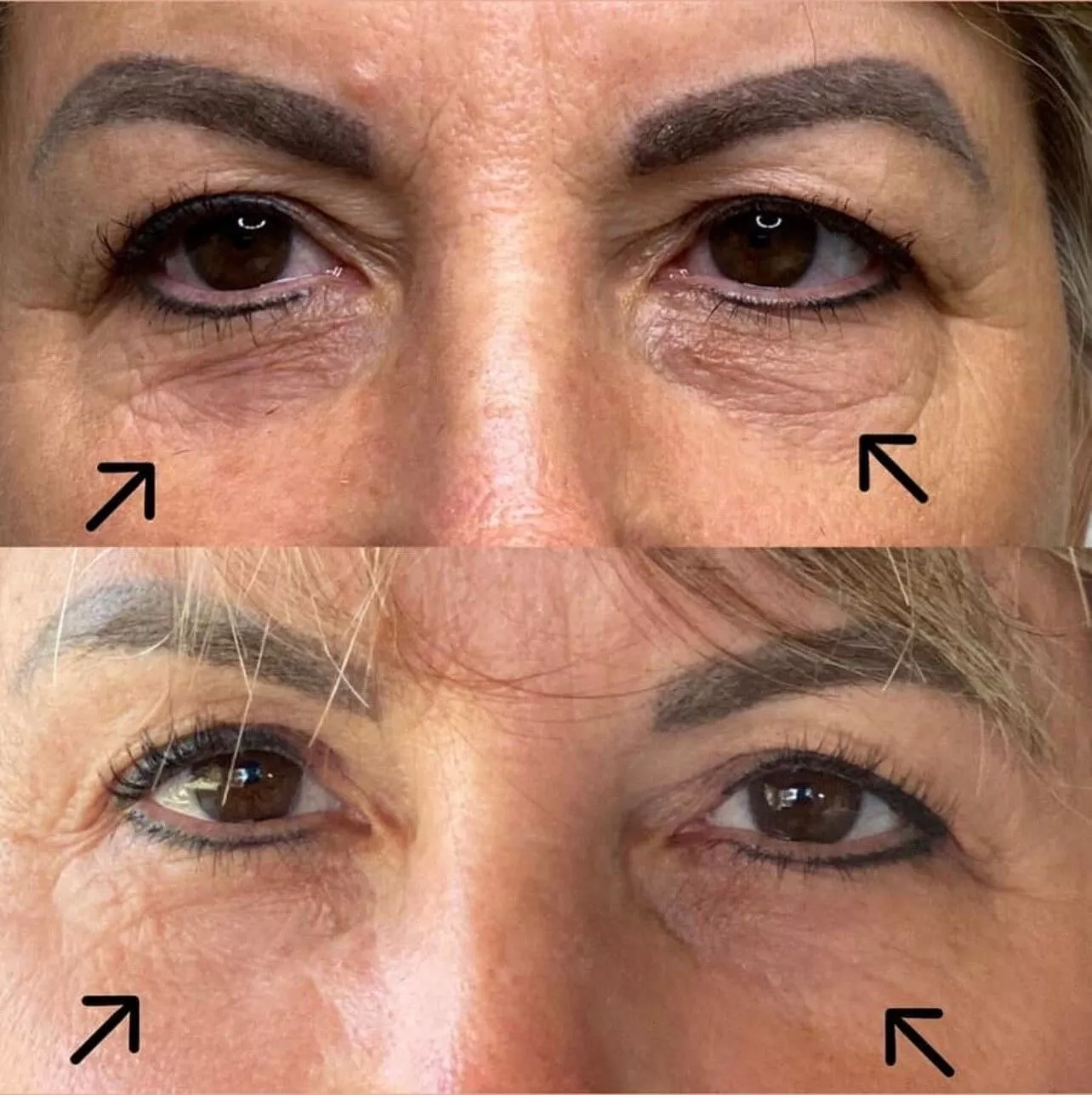 Cosmetic Thread Lift